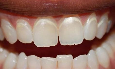White Line On Gums