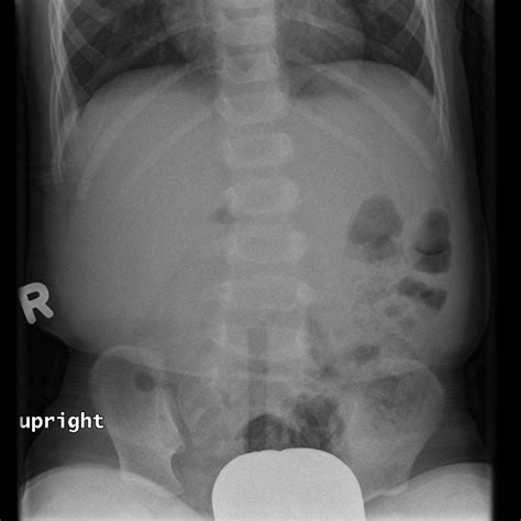 Target Sign Intussusception X Ray The Echogenic Bands Are Formed By Mucosa And Muscularis