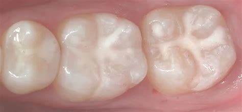 Selladores De Fosetas Y Fisuras Cosmodental