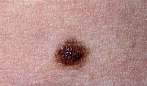 Neonatal Nevus
