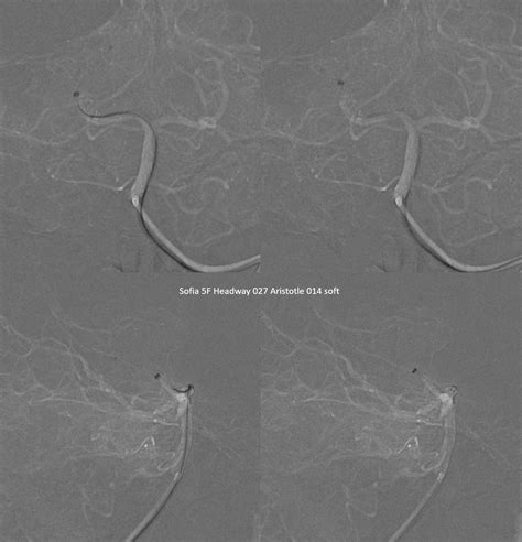 Pca Stroke Caution — Parallel Universe Pca Impostors — Circumflex And Choroidal