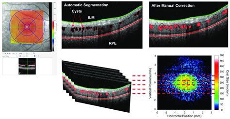 An Application Of Using Cyst Segmentation In Oct For A Patient With