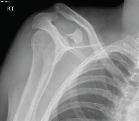 Acromioclavicular Joint Separation Archives Journal Of Urgent Care Medicine