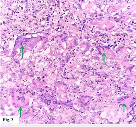 Histiocytic Multinucleated Giant Cells Green Arrows Hematoxylin And Download Scientific