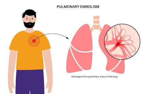How Long Before A Pulmonary Embolism Kills You 2025