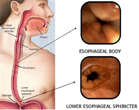 Upper Esophageal Sphincter Diagram Videofluoroscopy Guided Balloon
