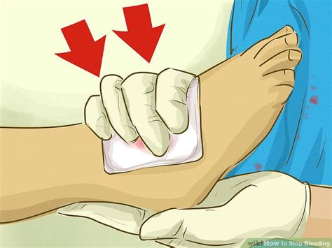 3 Ways To Stop Bleeding WikiHow