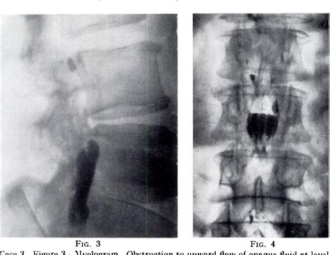 Polyradiculopathy Semantic Scholar