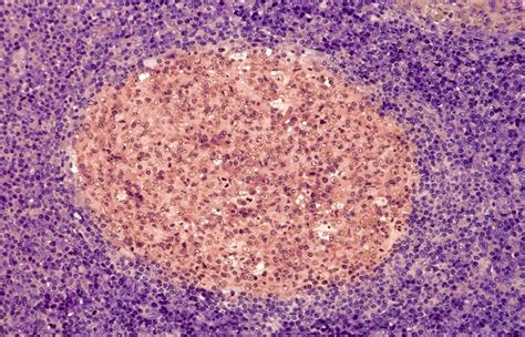 Lymph Node Light Micrograph Stock Image P2900046 Science Photo