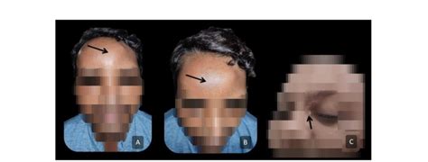 Physical Characteristics Of Patients With Frontal Bossing A And B And Download Scientific