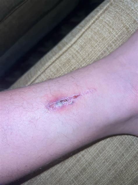 Is This Surgical Induction Infected Ankle Tibia Area R Medical