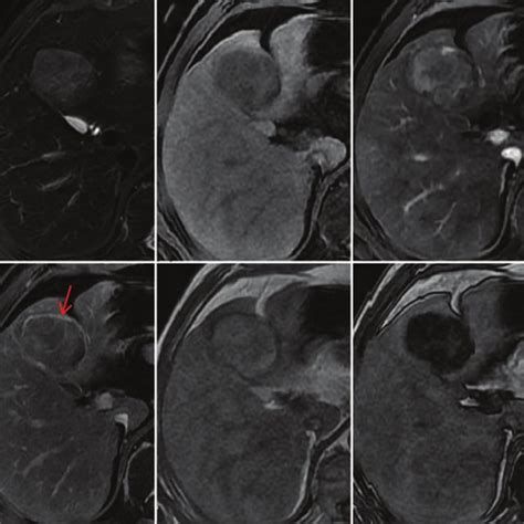 Targetoid Appearance In T2wi Fs A And Diffusion Weighted Imaging Download Scientific Diagram