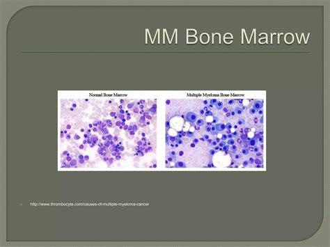 Plasma Cell Dyscrasia Pptx