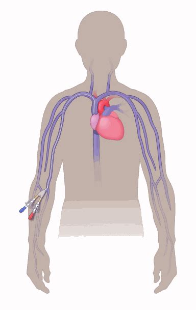 Vías Catéteres Y Puertos Intravenosos Iv Utilizados En El