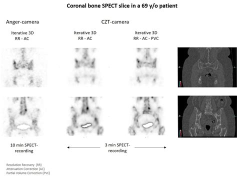A One Shot Whole Body Bone Spect May Be Recorded In Less Than 20 Minutes With The High
