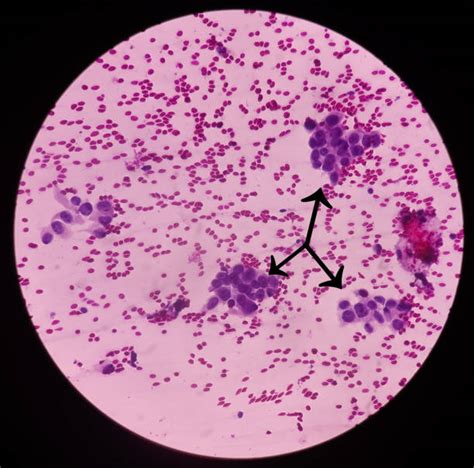 160개 이상의 액와림프절 스톡 사진 그림 및 Royalty Free 이미지 Istock