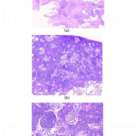 Hande Sections From A Right Upper Lobe Of Lung Wedge Resection Reveal