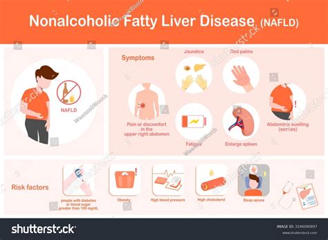 Vector Illustration Nonalcoholic Fatty Liver Disease Stock Vector