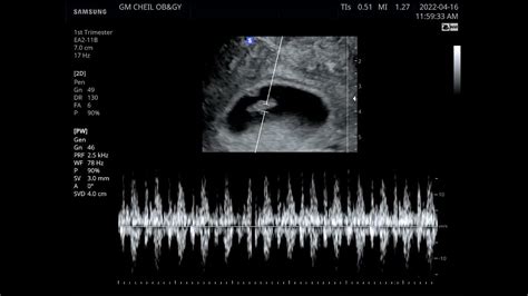 나은이의 성장일기 첫만남 두근두근 심장소리 Youtube