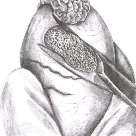 Microdissection Testicular Sperm Extraction Download Scientific Diagram