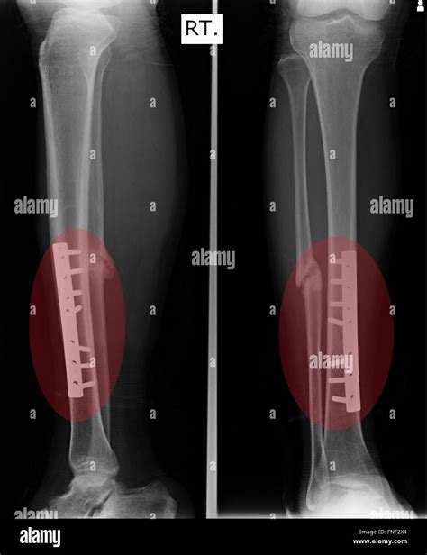 Fracture Elbow Forearm X Rays Image Showing Plate And Screw Fixation