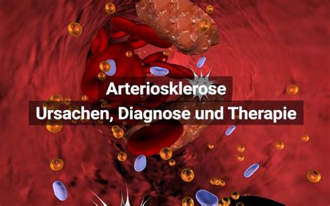 Arteriosklerose Ursachen Diagnose Behandlung And Folgen