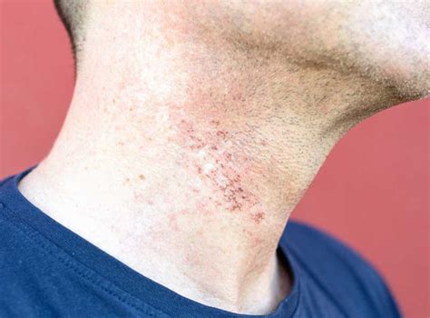 7 Essential Oils For Treating Shaving Scars Mens Soap Company