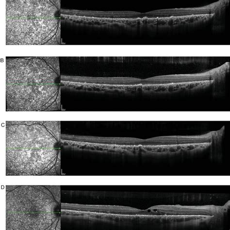 Spectral Domain Optical Coherence Tomography Sd Oct For P1 The Green Download Scientific