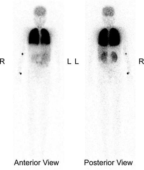 Technetium 99m Labeled Macroaggregated Albumin Scan Showing The Uptake