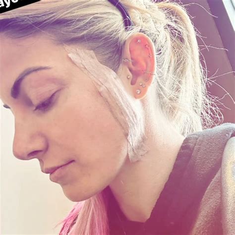 Wwes Alexa Bliss Shares Skin Cancer Diagnosis