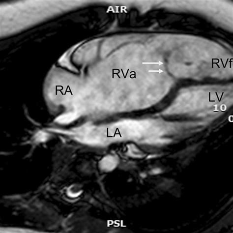 Pre And Post Operative Echocardiograms Using Color Compare And Cxr Download Scientific