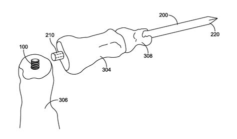 Hammer Toe Modification Surgery Allenkroesing Hammer Toe Modification Surgery Allenkroesing