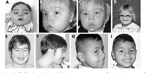 Trigonocephaly Symptoms