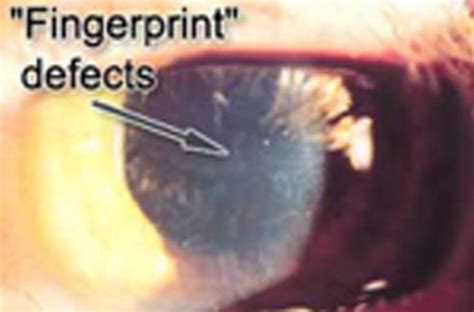 Map Dot Fingerprint Dystrophy