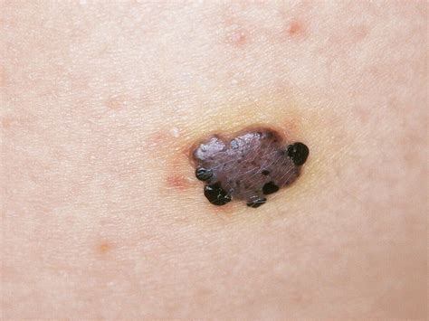 Angiokeratoma
