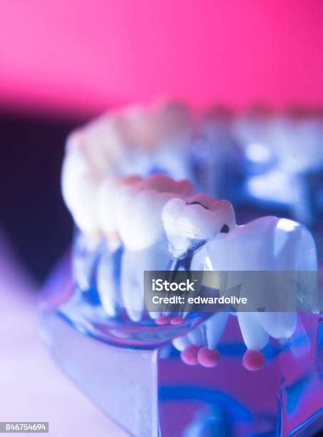 치과 의사 치과 치아 교육 각 치아 잇 몸 루트 임 플 란 트 부패 패 및에 나 멜을 보여주는 모델 3차원 형태에 대한 스톡 사진 및 기타 이미지 Istock