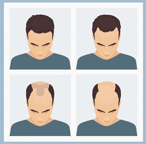 How To Counter Hair Loss Pattern In Men