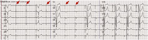 Frontiers Case Report An Elderly Woman With Recurrent Syncope After