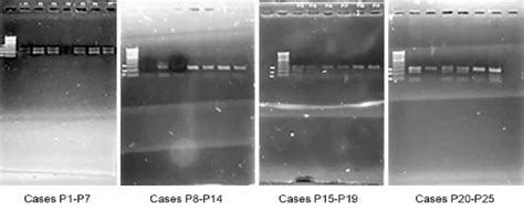 Polymerase Chain Reaction Products After Restriction Fragment Length