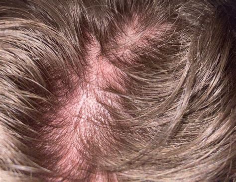 Покраснение кожи на ногах и зуд фото