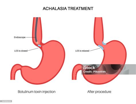 Esophageal Botulinum Toxin Injection Stock Illustration Download