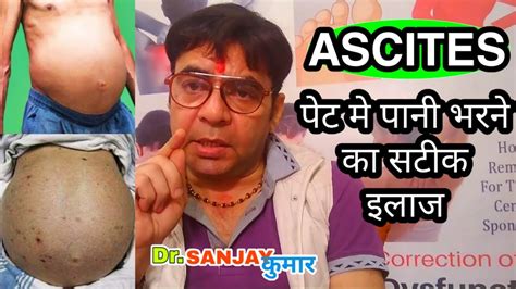 Ascites Treatment Naturally Cure Ascites How To Cure Ascites How To Get Rid Of Ascites YouTube