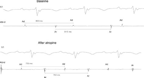 Surface Electrocardiogram And Atrial Electrogram Recordings Obtained Download Scientific