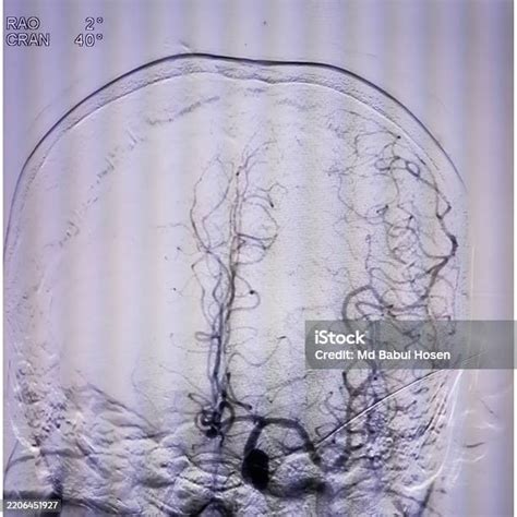 Digital Subtraction Angiography Or Cerebral Angiography Of Brain