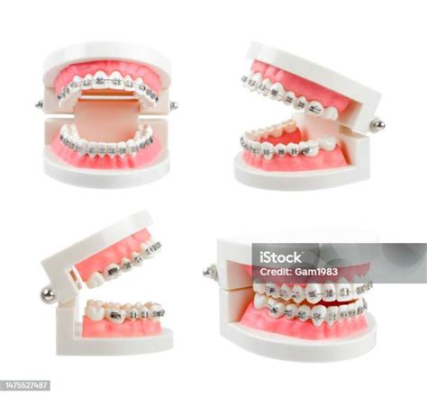 흰색 배경에 격리된 금속 와이어 치과 교정기 또는 치과 기구가 있는 치아 모델 세트 클리핑 경로 저장 0명에 대한 스톡 사진 및