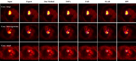 Lung Tumor Segmentation Results Delineated In Blue Obtained With