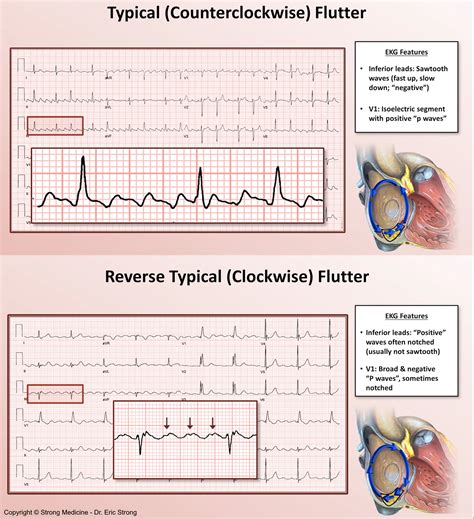 Atrial Flutter Sawtooth Ecg