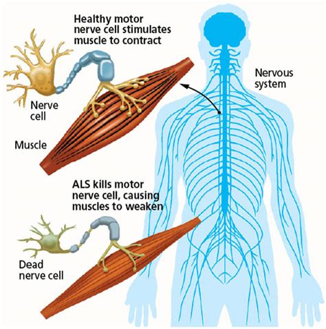 Quick Overview Of Als Cobbers On The Brain