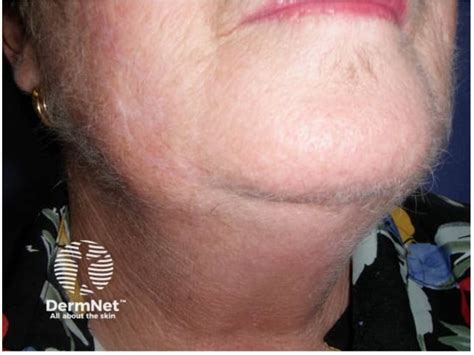 Hair Disorders Geeky Medics