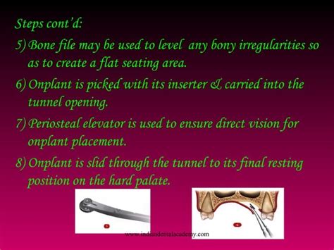 Implants In Orthodontics A Paradigm Shift Certified Fixed Orthodontic Courses By Indian Dental